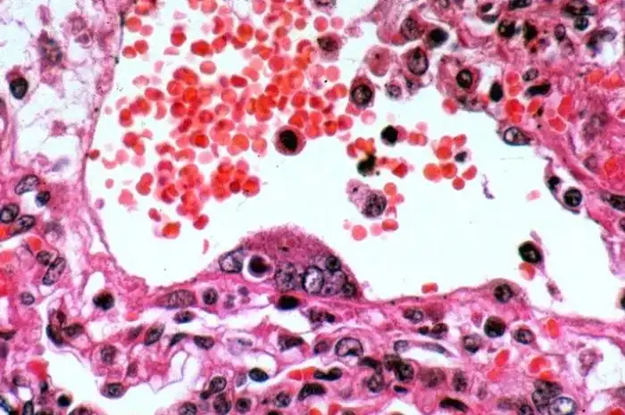 Apa Itu Virus Nipah? Kenali Gejala dan Cara Mencegahnya - Sonora.id