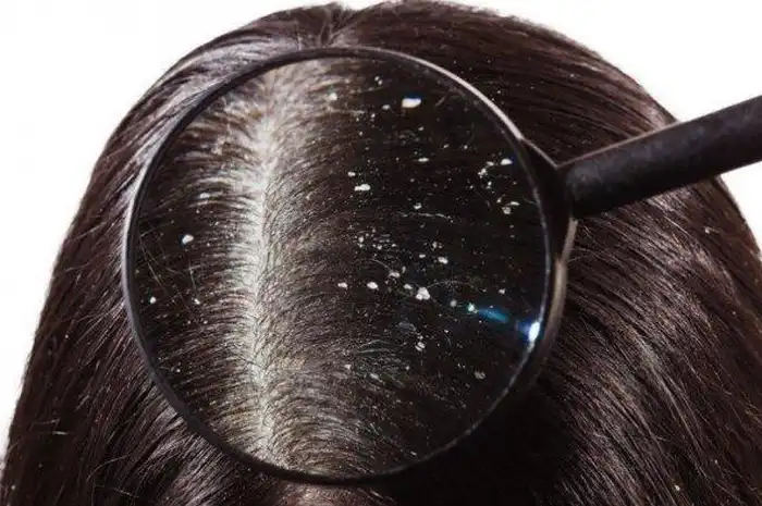 Ketombean Parah Hingga Kulit Kepala Luka? Bisa Jadi Gejala Psoriasis ...