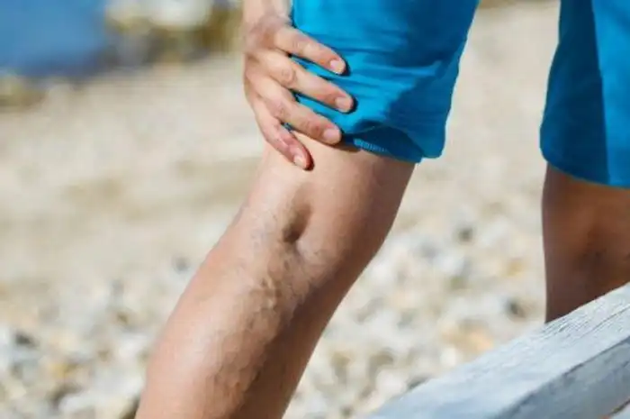 Cara Menghilangkan Varises pada Kaki yang Paling Benar, Begini ...