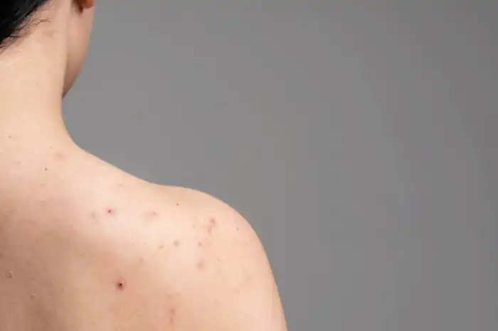 Bahaya! Herpes Zoster alias Cacar Ular Melingkar Bisa Sebabkan Kematian ...