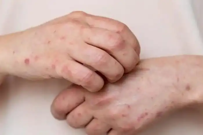 Amit-amit Telat Sadar, Kondisi Kulit Seperti Ini Gejala Kanker Leukemia ...