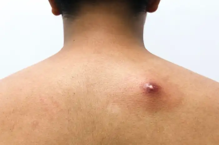 10 Cara Menghilangkan Bekas Bisul Secara Mudah, Tak Perlu Pusing ...
