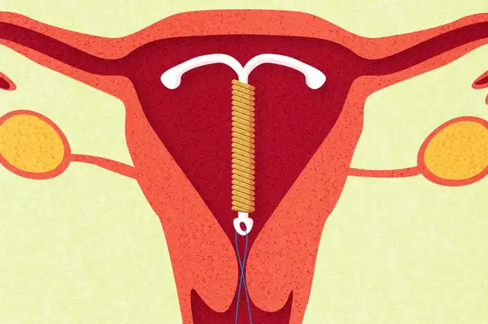 3 Efek KB IUD bagi Suami dan Cara Mencegahnya dengan Efektif - Sonora.id