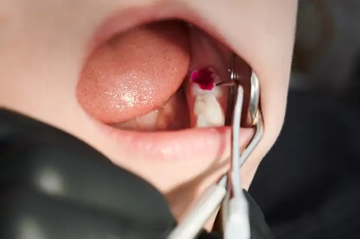 10 Cara Menghilangkan Sakit Gigi Berlubang Agar Tidak Kambuh Lagi - Sonora.id