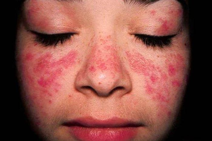 Kenali Lupus dari Gejala, Penyebab, Penanganan, dan Pencegahannya ...