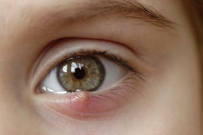 Alami Bintitan pada Mata? Ini Penyebab dan Pencegahannya - Sonora.id