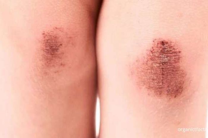 5 Cara Ampuh Hilangkan Koreng, Ternyata Bisa Pakai Kentang! - Sonora.id