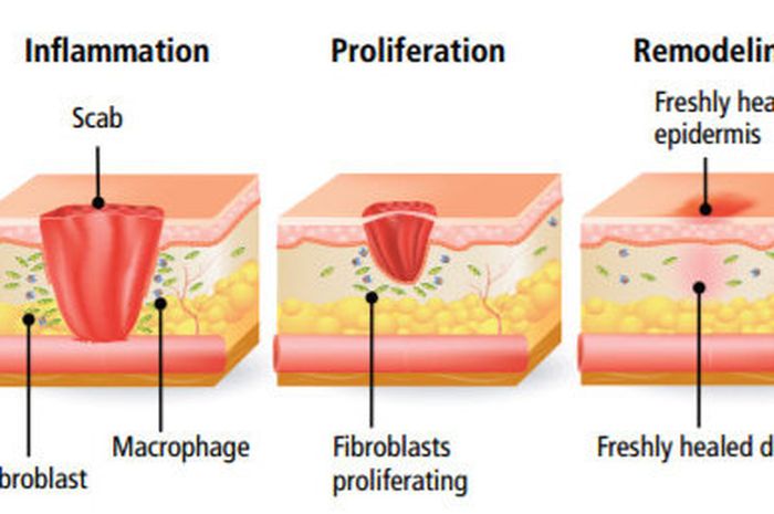 Berikut Ini adalah 3 Tahapan dalam Proses Penyembuhan Luka - Sonora.id