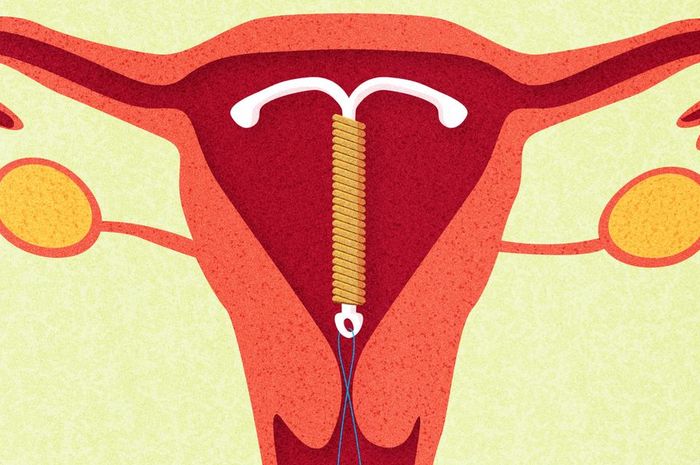 3 Efek KB IUD bagi Suami dan Cara Mencegahnya dengan Efektif - Sonora.id