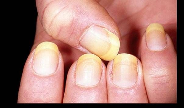 Kuku Kuning? Hati-hati, Bisa Jadi Tanda Penyakit Diabetes hingga Paru ...