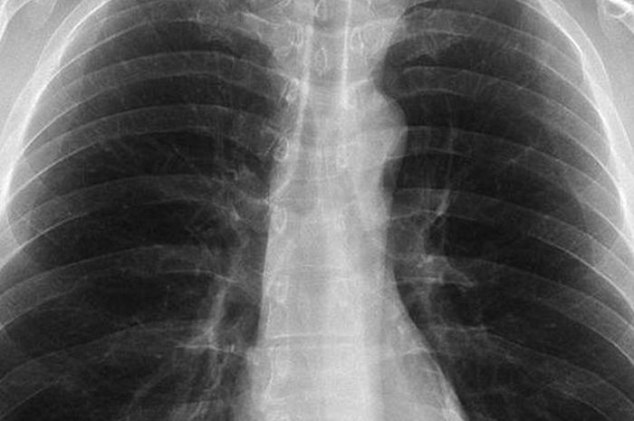 Penyebab Flek Paru-paru, Kenali Juga Gejala dan Cara Pencegahannya - Sonora.id