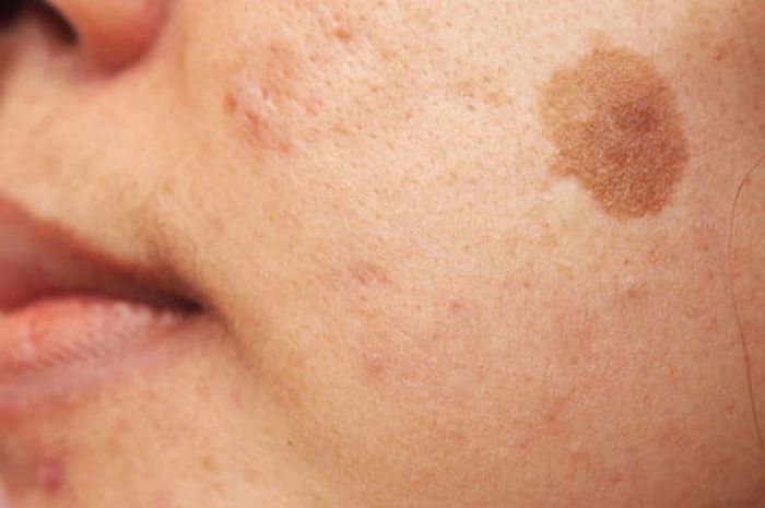 Kenali Flek dari Sisi Medis! Kata Dokter: Ini Tidak Berbahaya - Sonora.id