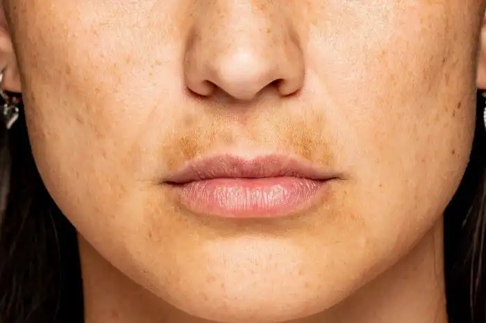 5 Penyebab Bintik Putih di Bibir, Nomor 5 Paling Mematikan! - Sonora.id