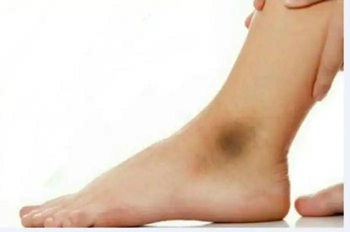 5 Cara Putihkan Mata Kaki yang Gelap secara Alami, Bisa Pakai Garam ...